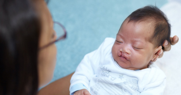 What you need to know about cleft lip and palate | Delta Dental