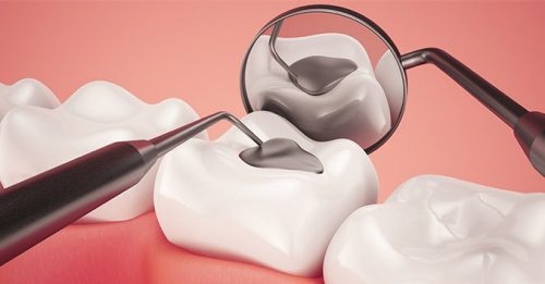 How to dispose of dental amalgam safely | Delta Dental