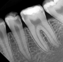 How to avoid claim denials for crowns, pt. 2 | Delta Dental