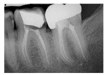 Endodontic Claims: Delta Dental's X-ray Submission Guide | Delta Dental