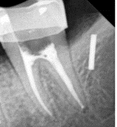 Endodontic Claims: Delta Dental's X-ray Submission Guide | Delta Dental