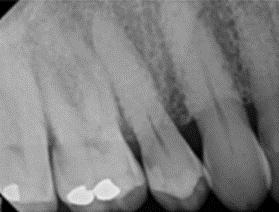 How to avoid claim denials for crowns | Delta Dental