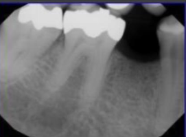 How to avoid claim denials for crowns | Delta Dental