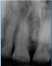 How to avoid claim denials for crowns | Delta Dental