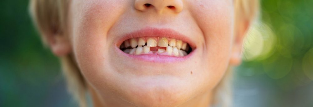 What to do when your child knocks a tooth loose | Delta Dental