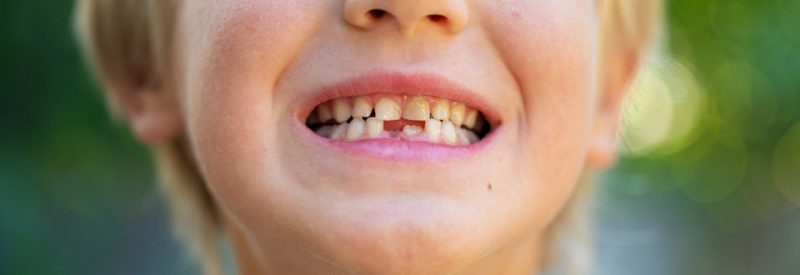 What to do when your child knocks a tooth loose | Delta Dental