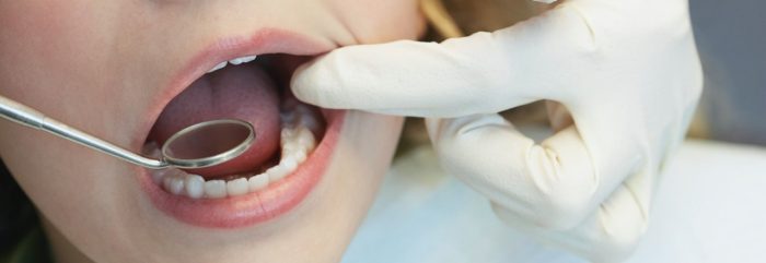 Stop cavities with sealants | Delta Dental